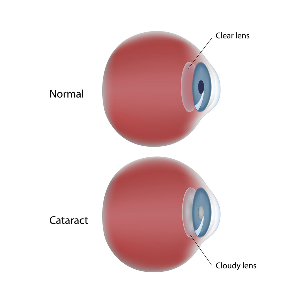 Behandeling cataract door cataractoperatie | Visionair oogzorg